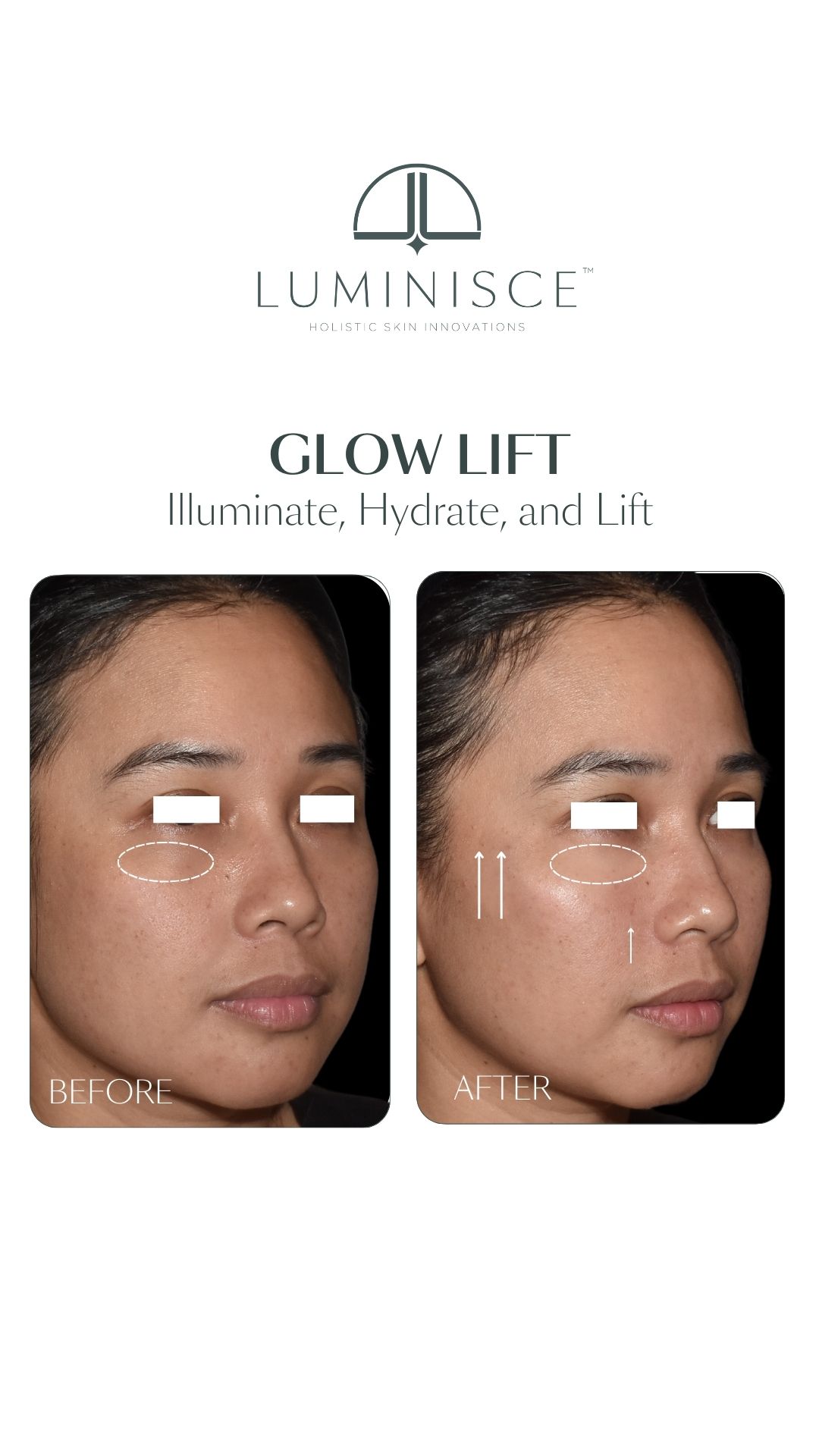 Luminisce Introduces Teoxane’s Glowing Lift: A New Era in Non-Surgical ...